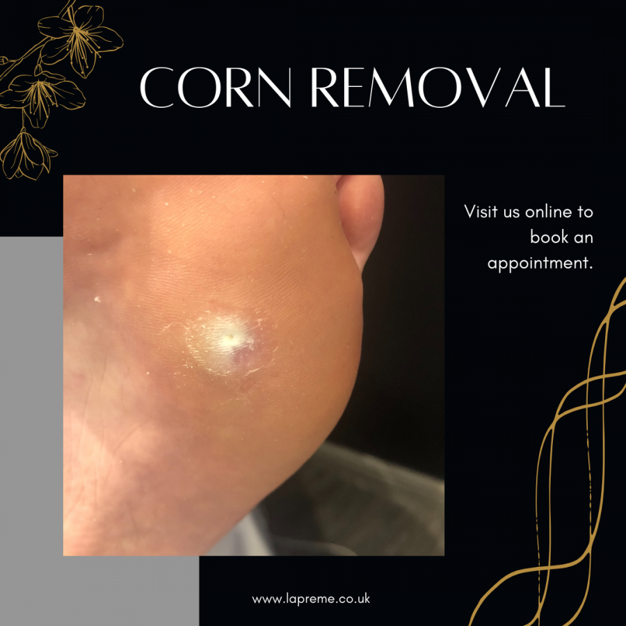 Corn Removal & Corn Treatment Glasgow - La Preme